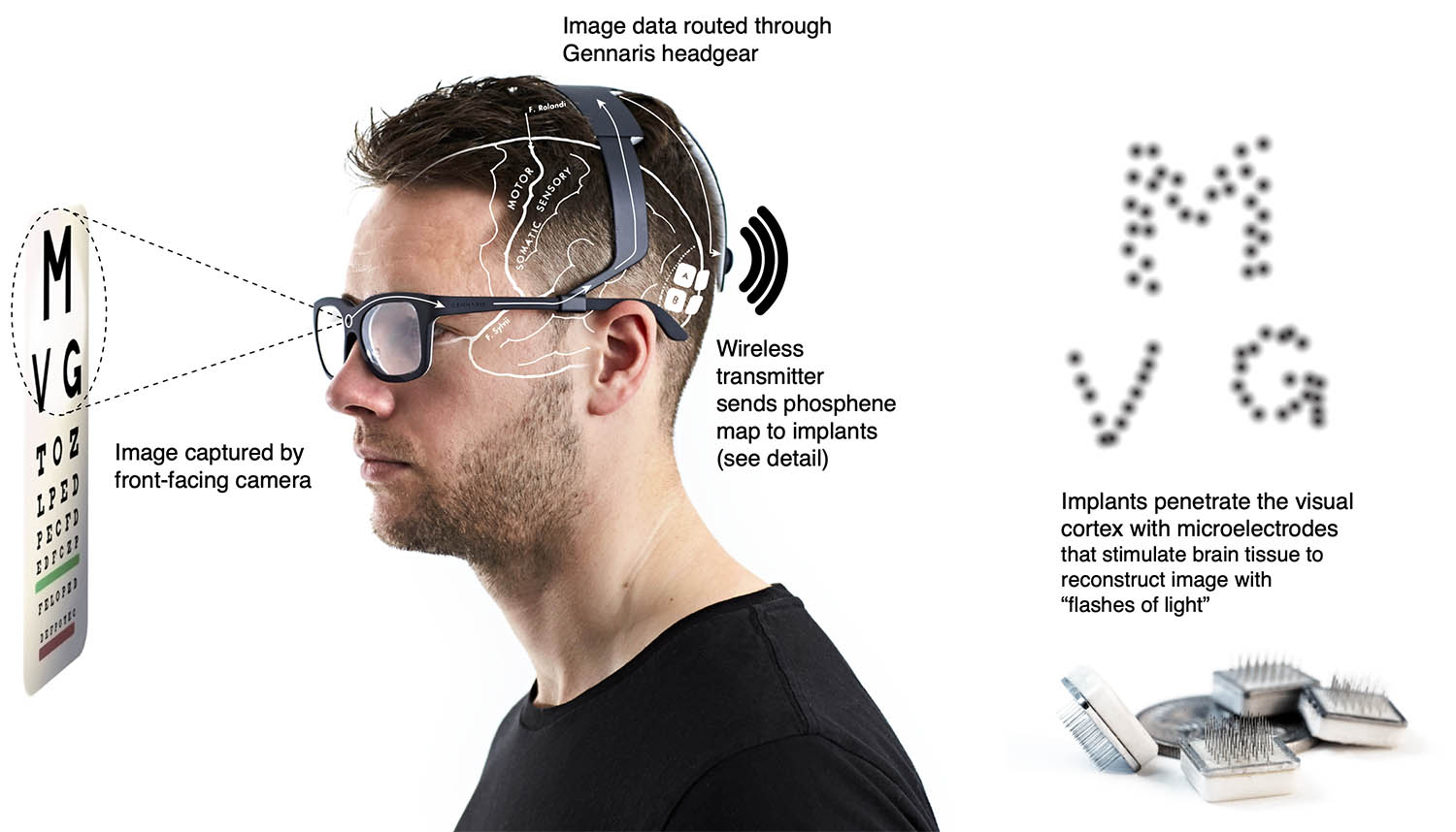 World’s First Bionic Eye Developed To Restore Vision In Blind People ...