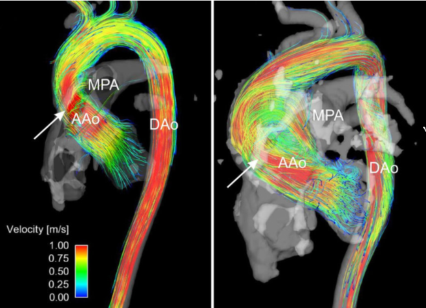 4D flow MRI to quicker diagnose aortic stenosis – Quomi – Healthcare ...