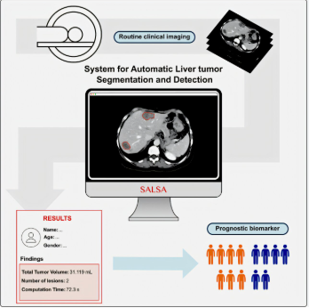 Liver cancer segmentation and detection with ‘SALSA’ – Quomi – Healthcare meets Social