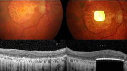 Tiny AI-powered eye implant helps the blind see again - Quomi ...