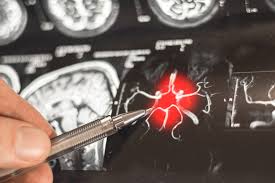 Evidence links gut microbiome changes to Alzheimer’s progression ...